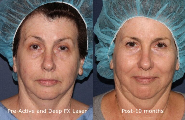 Active Deep FX Laser Resurfacing | San Diego, CA | CLDerm
