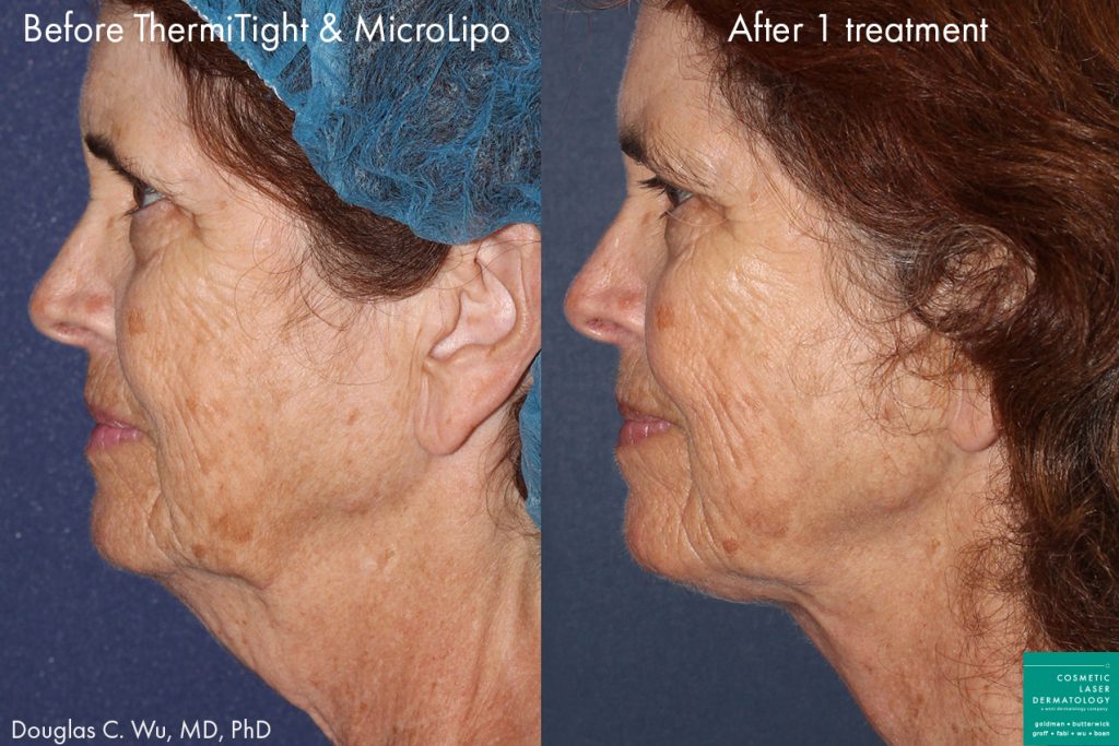 Non-Surgical Chin Contouring Dermatologist | San Diego, CA | CLDerm