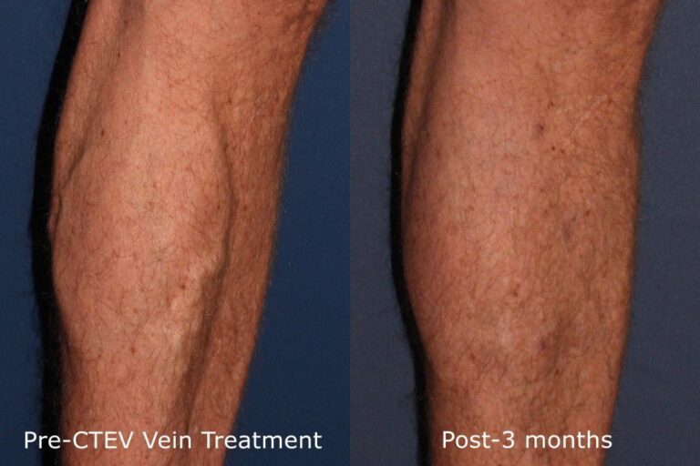 CoolTouch CTEV Laser Vein Removal | San Diego, CA | CLDerm