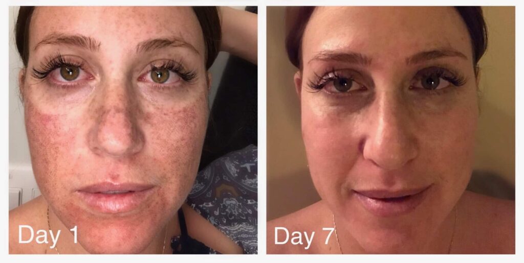 Fraxel Re:store Dual Laser Resurfacing | San Diego, CA | CLDerm