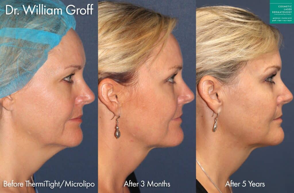 Non-Surgical Chin Contouring Dermatologist | San Diego, CA | CLDerm