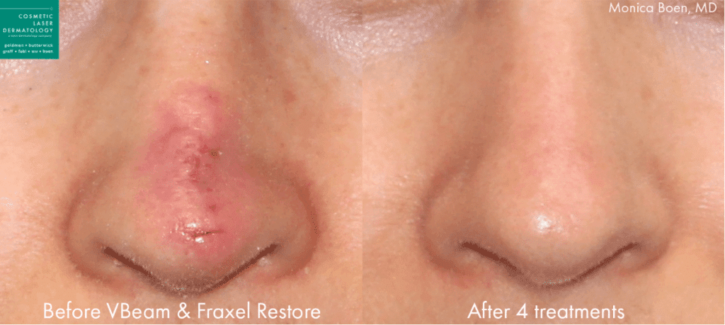 Say Goodbye to Unsightly Scar Tissue with Scar Revision Treatments