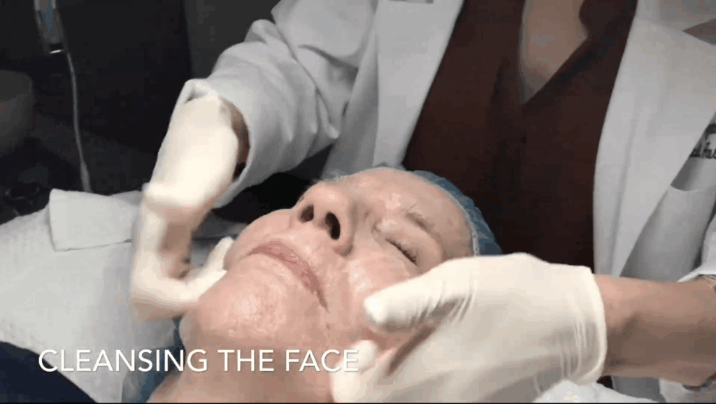 Chemical Peel Medical Spa | San Diego, CA | CLDerm
