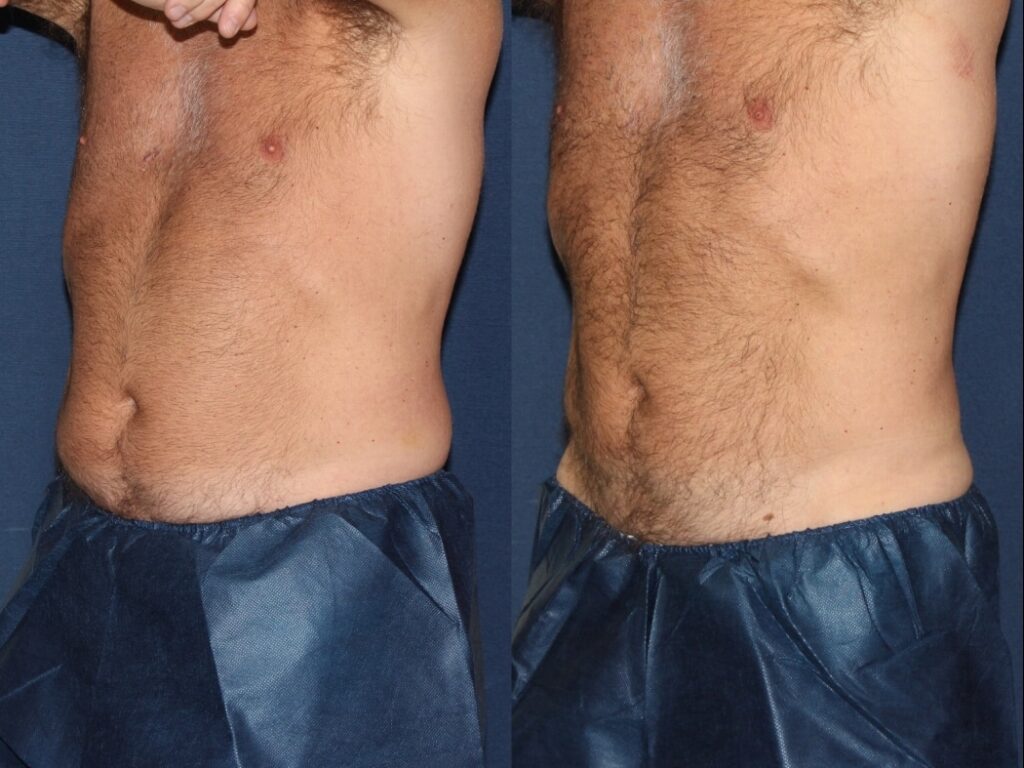 Coolsculpting for Men San Diego, CA | Cosmetic Laser Dermatology