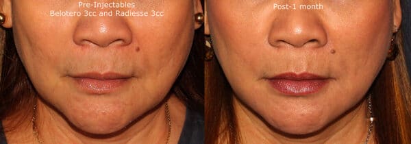 Wrinkles and Sagging Around the Mouth - Cosmetic Laser Dermatology Skin ...