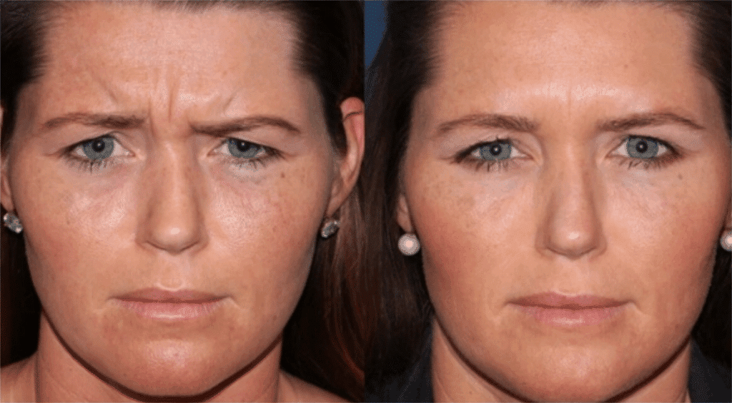 Botox Can Do That? - Cosmetic Laser Dermatology Skin Specialists in San ...