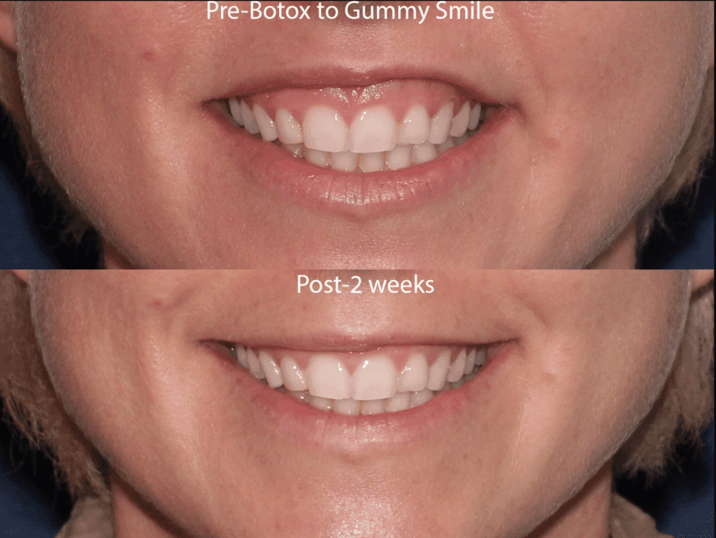 Botox Can Do That? - Cosmetic Laser Dermatology Skin Specialists in San ...