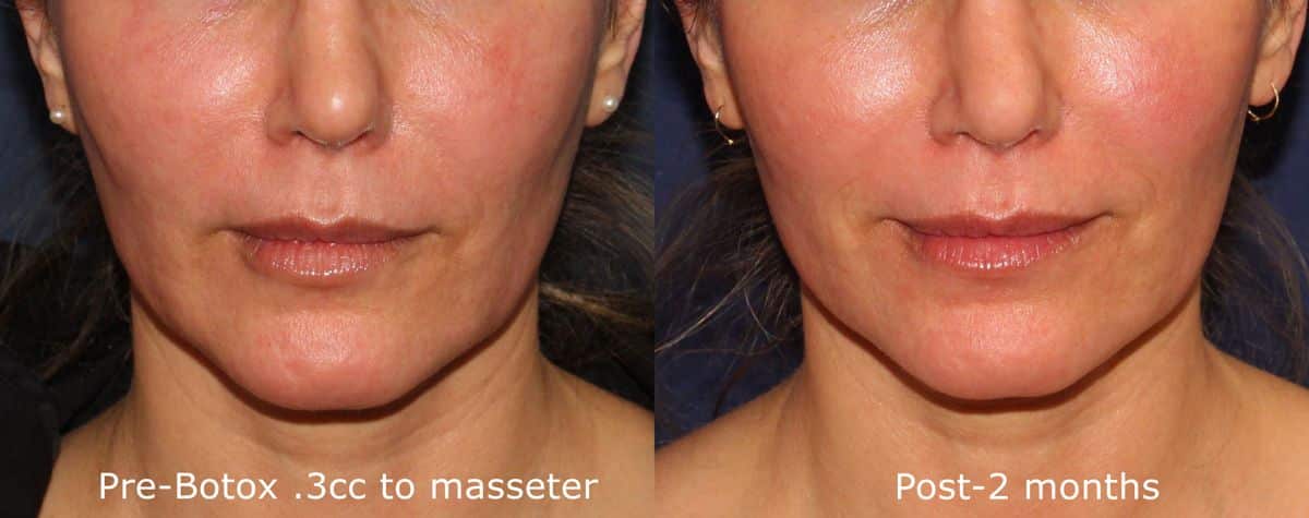 Botox Can Do That? - Cosmetic Laser Dermatology Skin Specialists in San ...