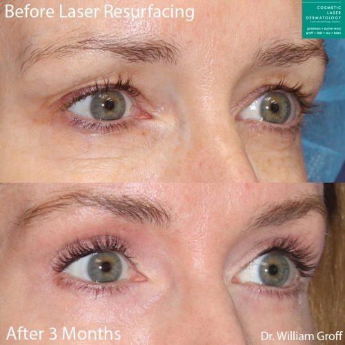 Eye Rejuvenation Cosmetic Laser Dermatology Skin Specialists In San Diego