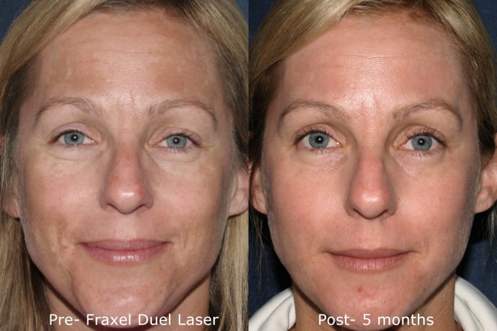 Best Treatments for Your Best Fall - Cosmetic Laser Dermatology Skin ...