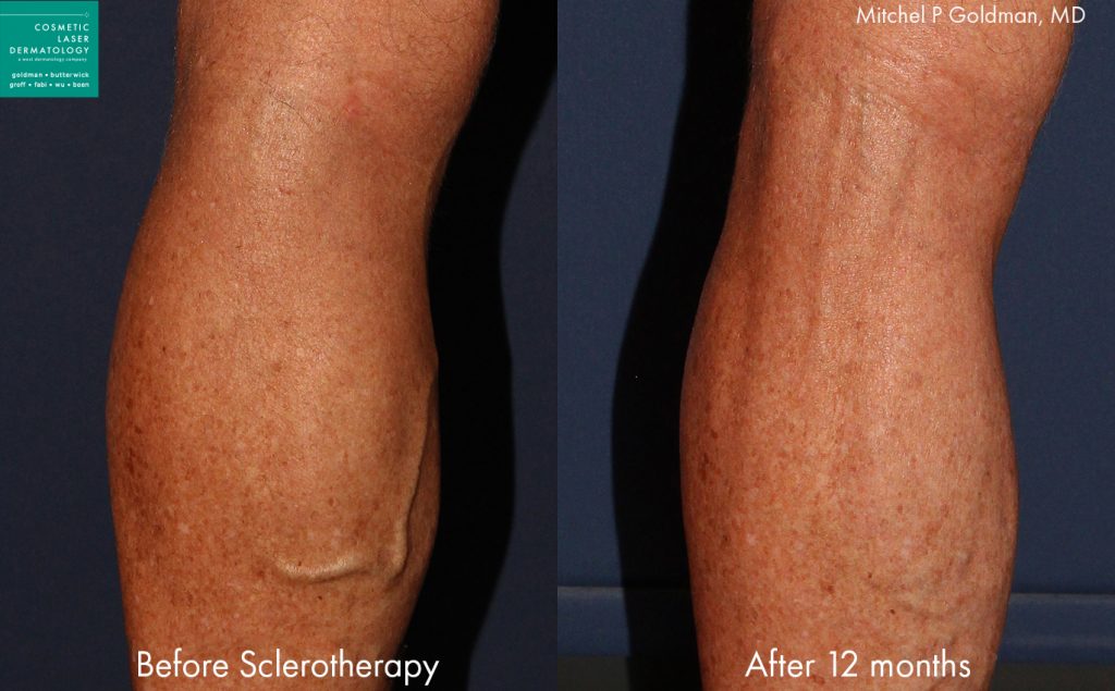 Is Sclerotherapy Safe? - Cosmetic Laser Dermatology Skin Specialists in ...