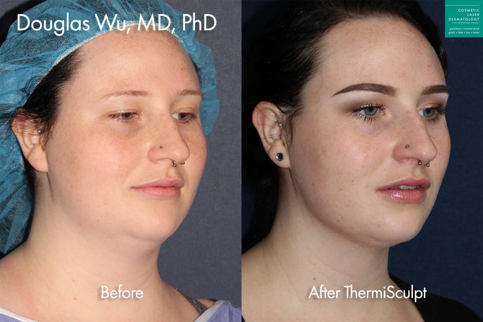 How To Get Rid Of Jowls Cosmetic Laser Dermatology Skin Specialists