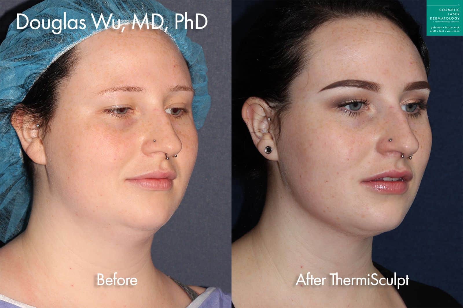 How to Get Rid of Loose Skin Under Your Chin Without Surgery - Cosmetic ...