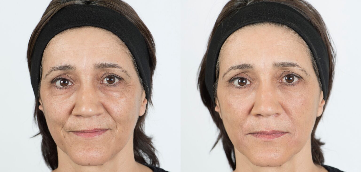 Redensity RHA Fillers | San Diego, CA | CLDerm