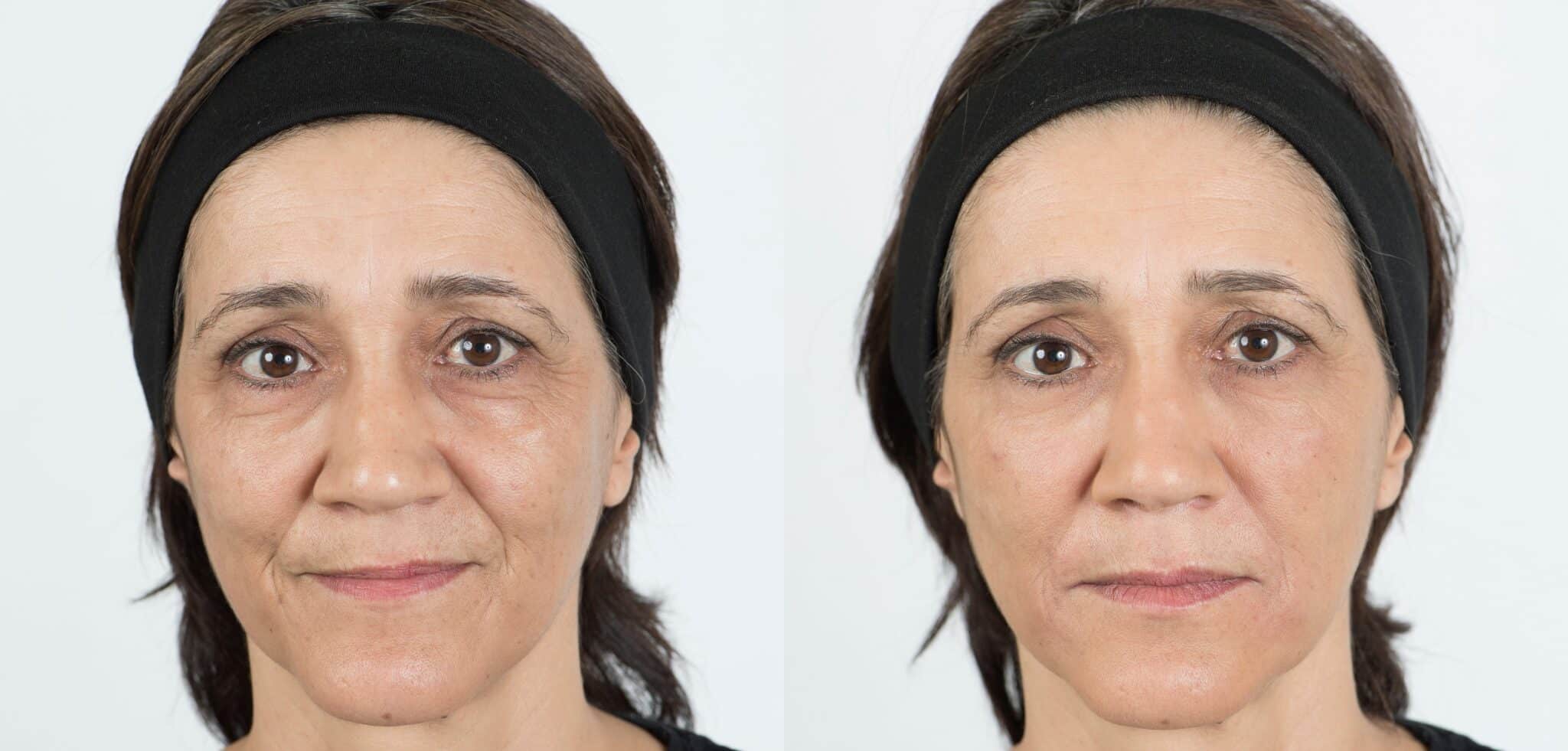 Redensity RHA Fillers | San Diego, CA | CLDerm