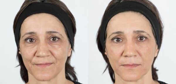 Redensity RHA Fillers | San Diego, CA | CLDerm