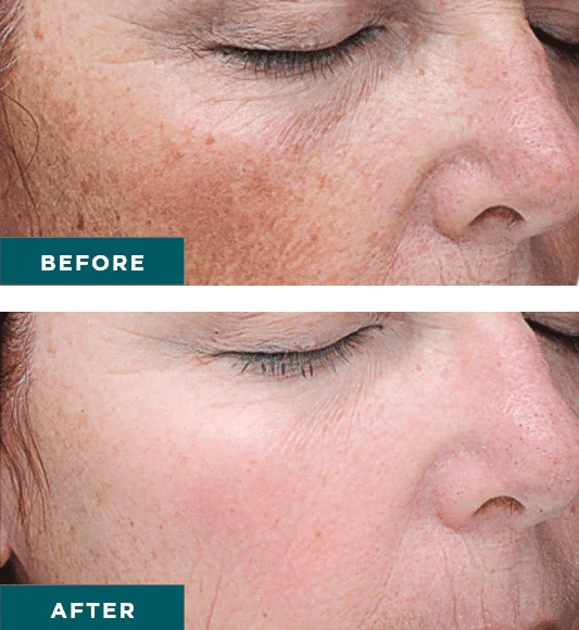 VI Peel Procedure | San Diego, CA | CLDerm
