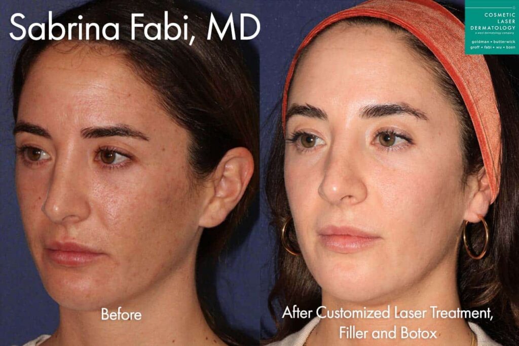 Botox Brow Lift in San Diego: Expert Treatment for Hooded Eyes ...