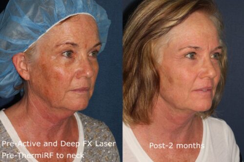 Ablative Laser Resurfacing vs. Non-Ablative Laser Treatments: Choosing ...