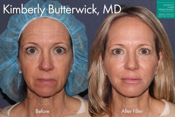 How We Treat Wegovy Face & Facial Volume Loss | CLDerm