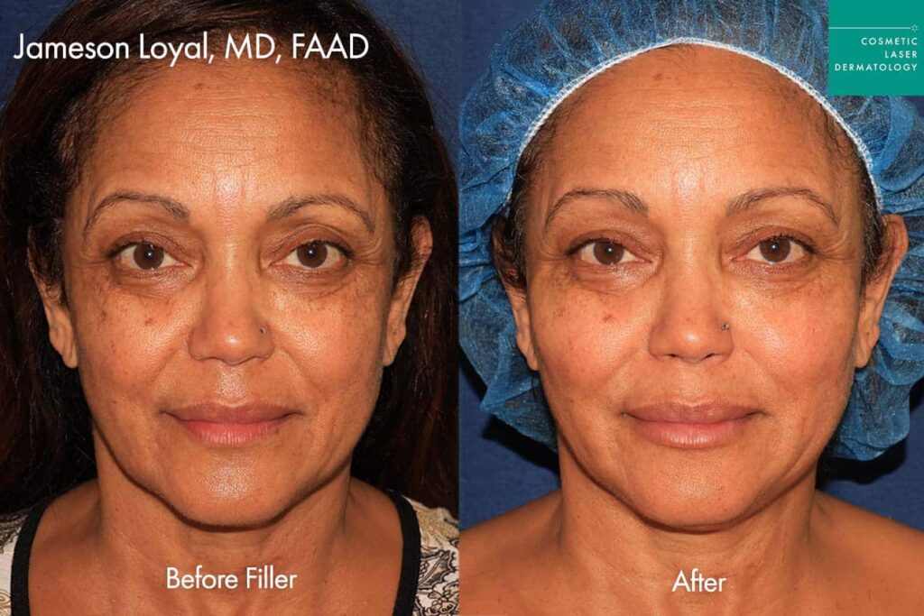 Combatting Dynamic Wrinkles with RHA Dermal Fillers - Cosmetic Laser ...