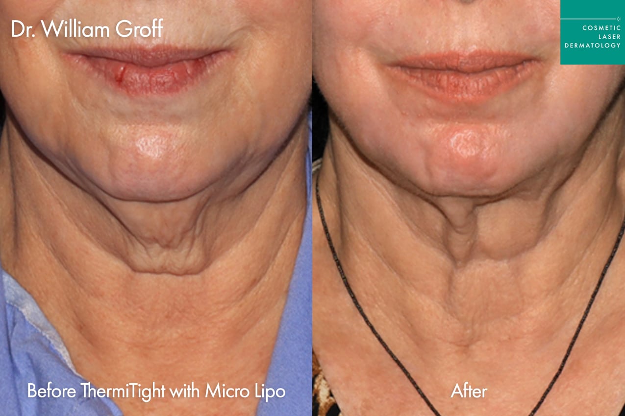 How To Get Rid Of Neck Lines: Dermatologists Talk About the Causes and ...