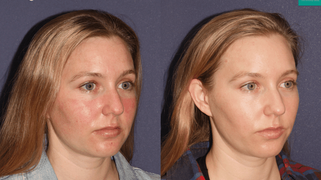 Before Your IPL Treatment